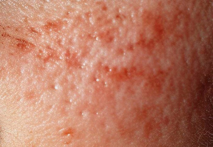 Info-Veranstaltung - Wenn Haut auf Haut trifft: Was hilft gegen die ...