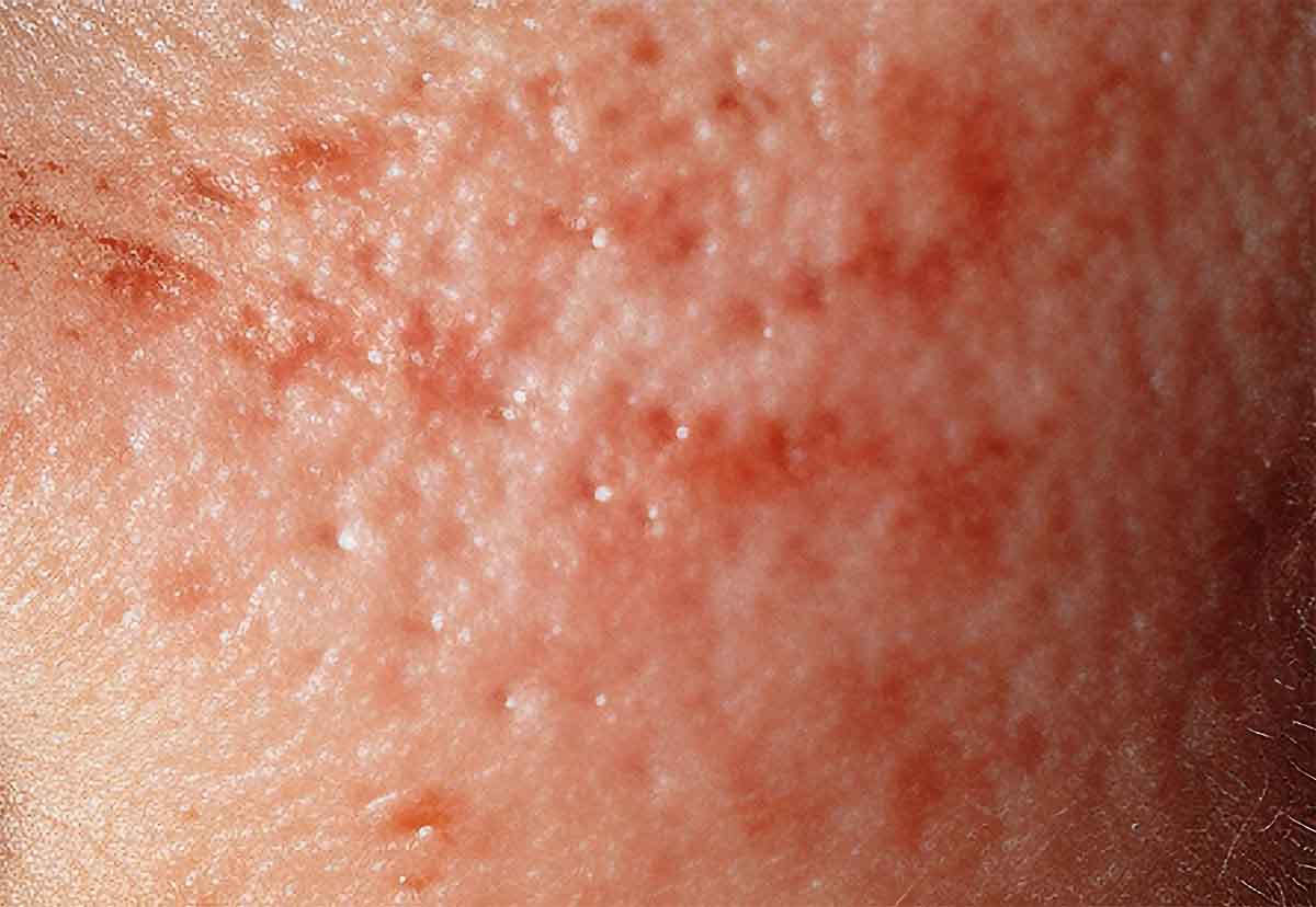 Info-Veranstaltung - Wenn Haut auf Haut trifft: Was hilft gegen die ...